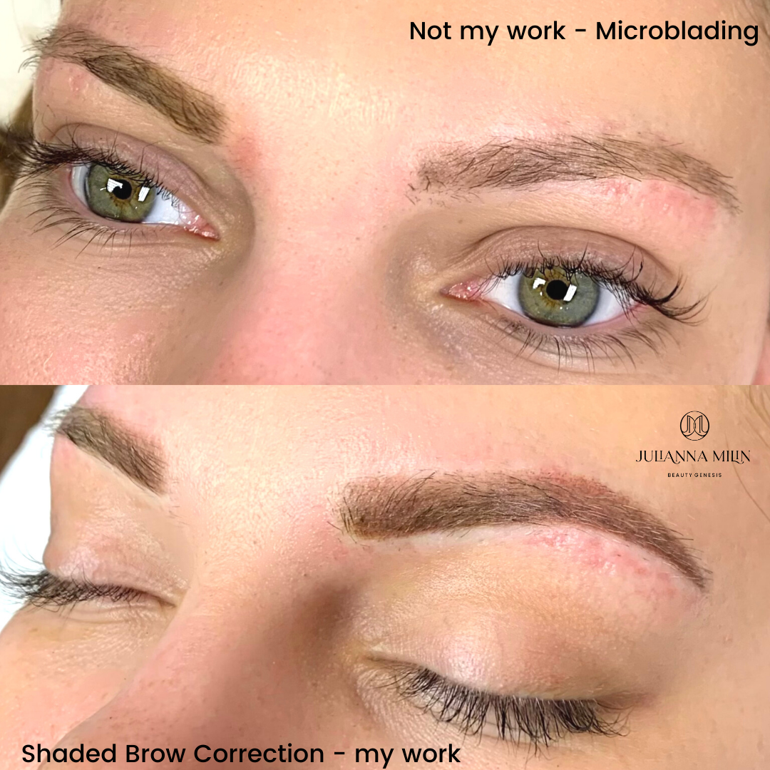 When to Get PMU Removal, and When Not to!